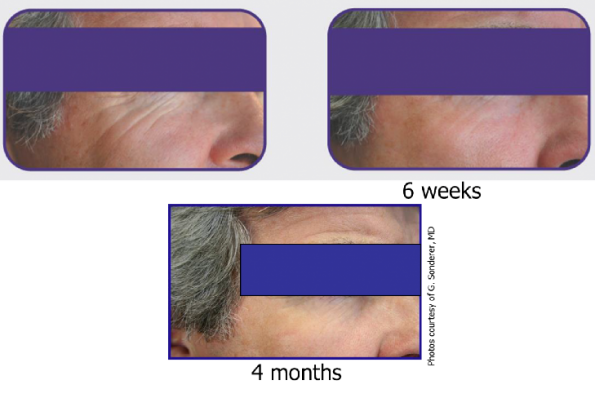 NEOGEN Nitrogen Plasma Treatment - Karpati Skin Clinic - Double Bay, Sydney