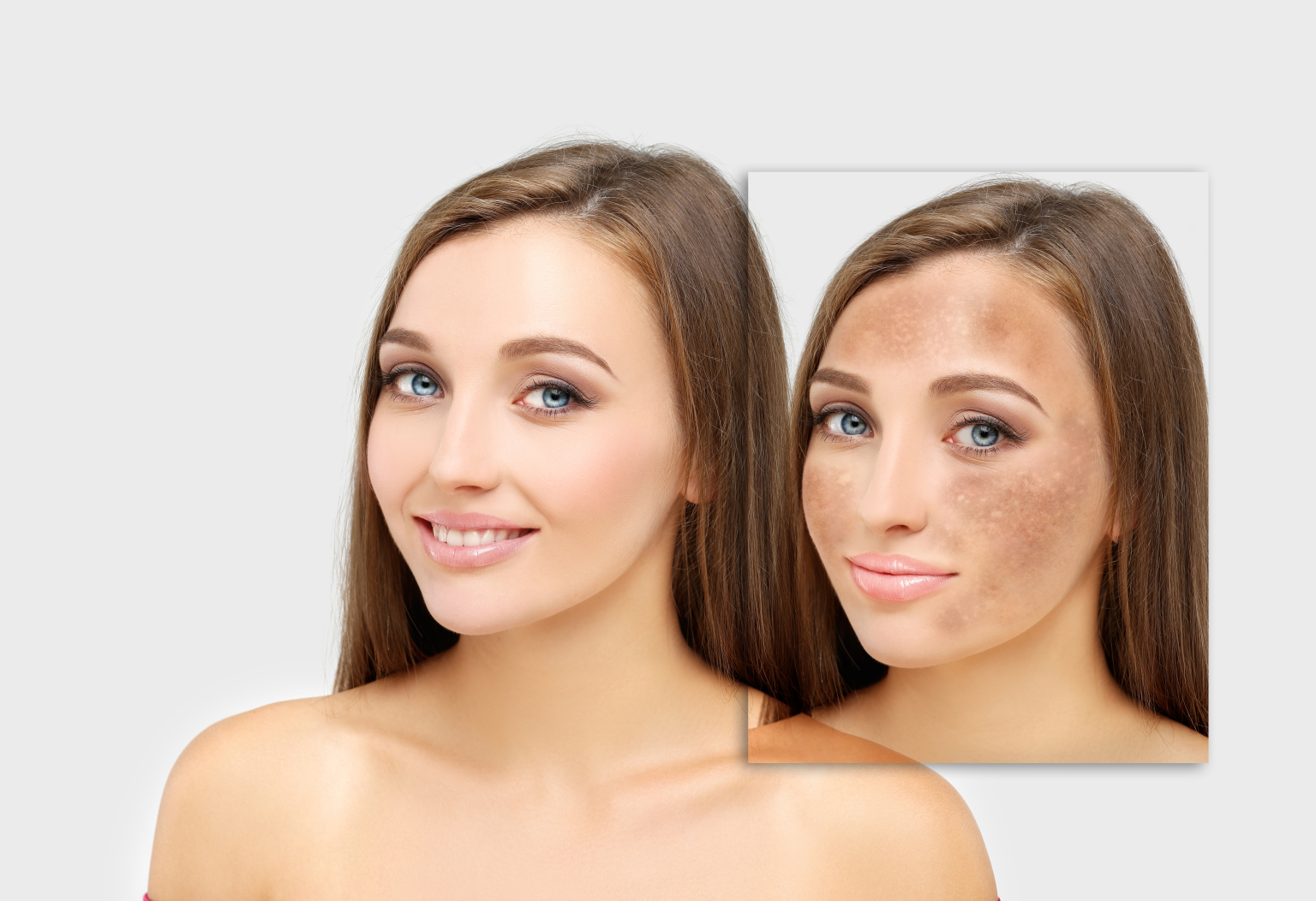 Winter Glow: Embrace Flawless Skin with Pigmentation Treatments ...